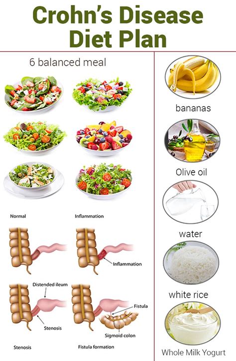 Crohns Disease Diet Plan Foods To Eat Avoid And Tips Artofit