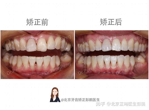 牙齿不齐还有缺失牙，该先种牙还是先正畸？ 知乎