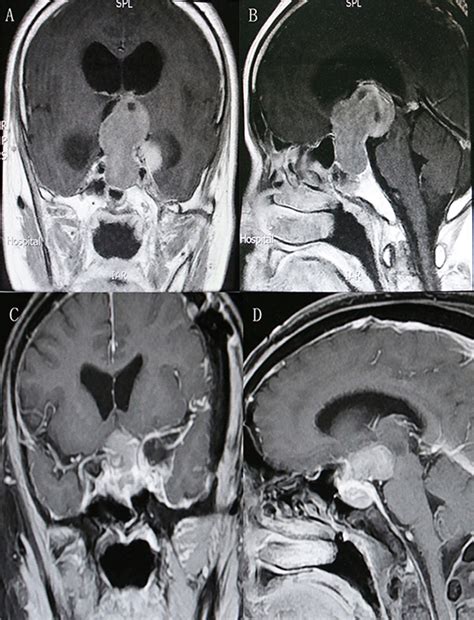 Clinical Features And Management Of Nonfunctioning Giant Pituitary