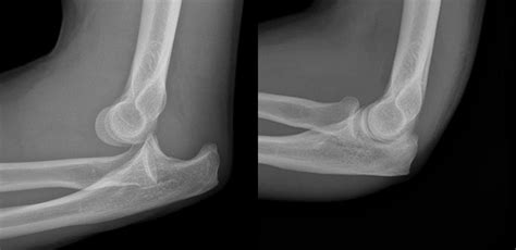 Ortho Globe Simple Elbow Dislocation