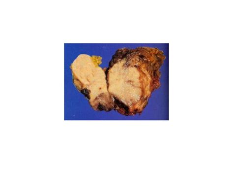 Pathology Of Thymus Pptx