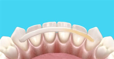 Temporary Dental Splint At Johnnie Hart Blog