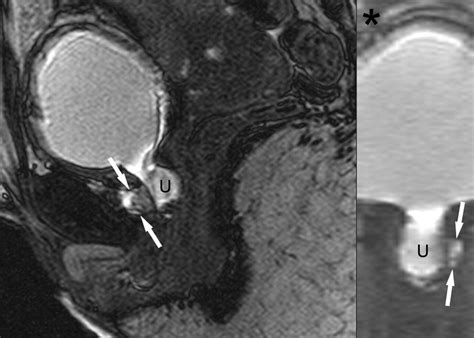 Ct Voiding Cystourethrography Using 16 Mdct For The Evaluation Of