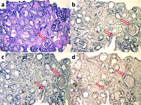 A Prostate Cancer Gleason Scored 6 Showing Architectural And Download Scientific Diagram