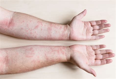 Itchy Rash Celiac At Kate Mackinlay Blog