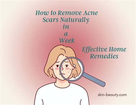 How To Remove Acne Scars Naturally In A Week Skin Beauty