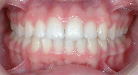 Orthodontic Corner Design And Management Of Twin Blocks