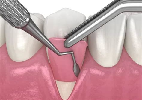 Periodontal Plastic Surgery Alliance Dental Surgery