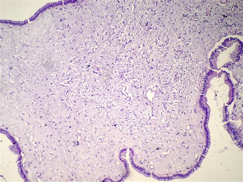 Fibroepithelial Polyp Hande ×100 Download Scientific Diagram