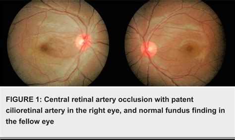 Central Retinal Artery Occlusion Anatomy