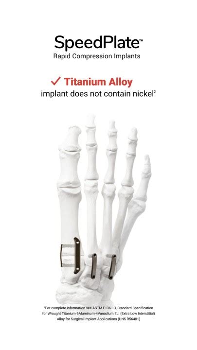 Speedplate™ Rapid Compression Implants For Surgical Implant Treace