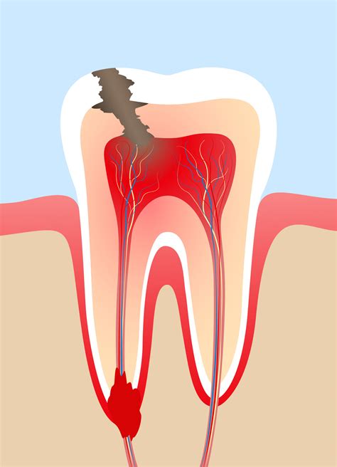 辽源治牙周炎正规医院推荐39健康网保健