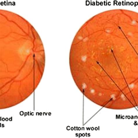 An Abnormality Detection Of Retinal Fundus Images By Deep Convolutional