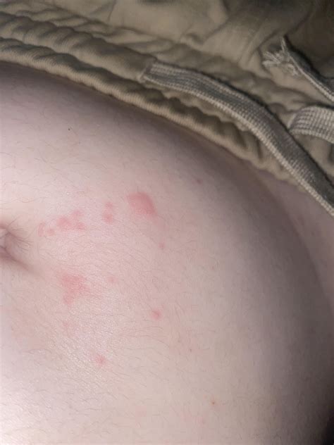 Are These Bites Please Someone Let Me Know R Bugbites