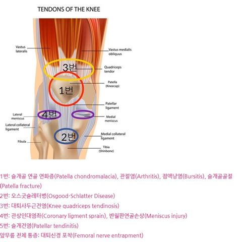 무릎 통증으로 손상 부위를 예측 할 수 있는가