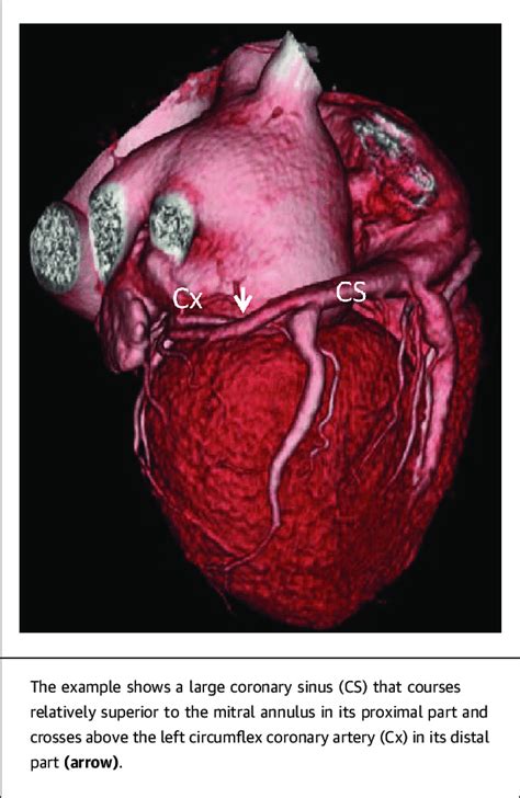 Multidetector Row Computed Tomography For Assessment Of The Size And Download Scientific