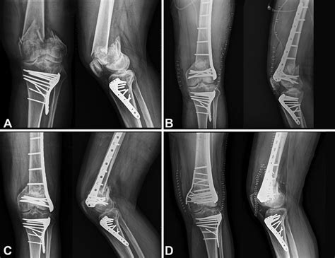 A D A A Preoperative Radiograph Shows Ota C Type Fracture With Download Scientific Diagram