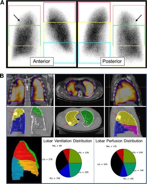 Nuclear Medicine Spect Test At Paul Harlan Blog