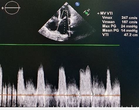 Apical Four Chamber View Showing A Mean Pressure Gradient Of 14 Mmhg Download Scientific