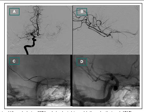 Figure 4 From Emergent Large Vessel Occlusion Due To Intracranial Stenosis Identification