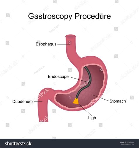 Gastroscopy Procedure Examination Esophagus Stomach Duodenum Stock