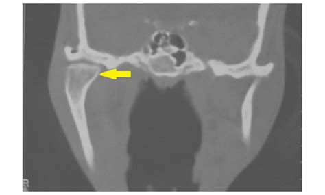 A Coronal Computed Tomography Ct Scan Showing Enlargement Of Right