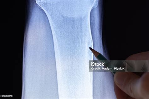 Doctor Examining Osteoid Osteoma Benign Bone Tumor Xray And Mri Mrt Ct