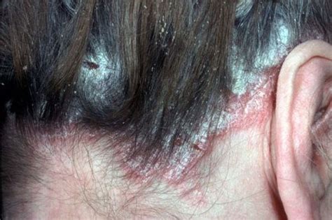 Best Psoriasis Shampoo For 2020 Reviews And Recommendations For The