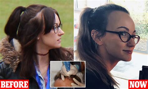 Receding Hairline Women Hairstyles