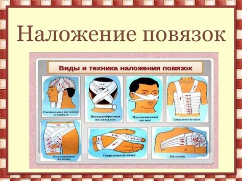 Наложение повязок. Виды повязок - презентация онлайн