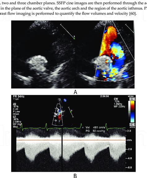 A D Echo With Color Flow Doppler Showing Severe Narrowing Of The Download Scientific Diagram
