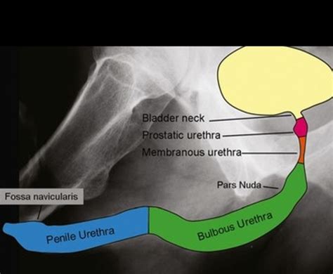 Retrograde Urethrogram Rgu