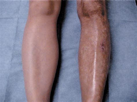 Linear Scleroderma Leg