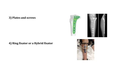 Distal Femur Patella Proximal Tibia Fracture Pptx