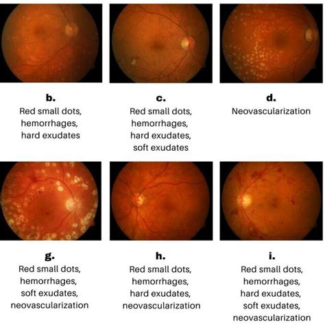 Proposed Dr Unet For Lesion Segmentation For Detection Of Diabetic Download Scientific Diagram