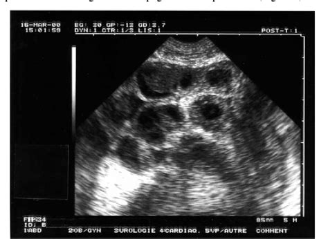 Infarctus Mésentérique Anses Agglomérées Dans Le Pelvis à La Paroi