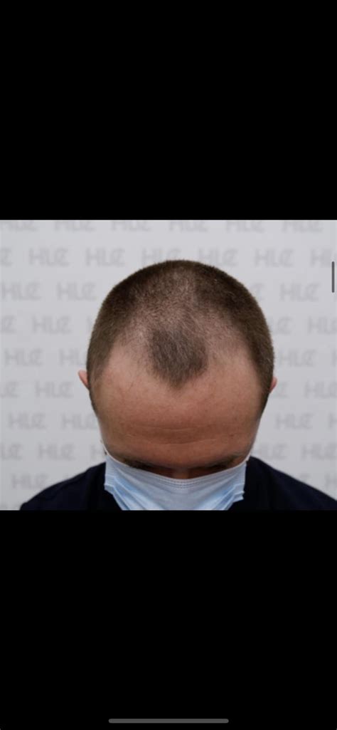 Hlc Ankara 6 Month Update 2753 Grafts Rhairtransplants