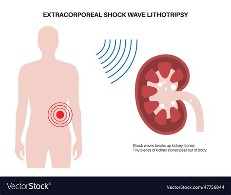 Lithotripsy Procedure Concept Royalty Free Vector Image
