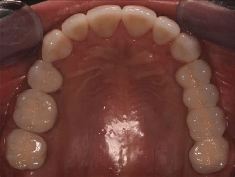 Post Operative Occlusal View Of The Maxillary Arch Download