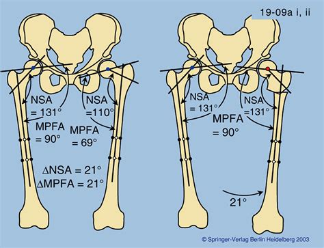 Surgery For Residual Femoral Deformity In Adolescents Orthopedic Clinics