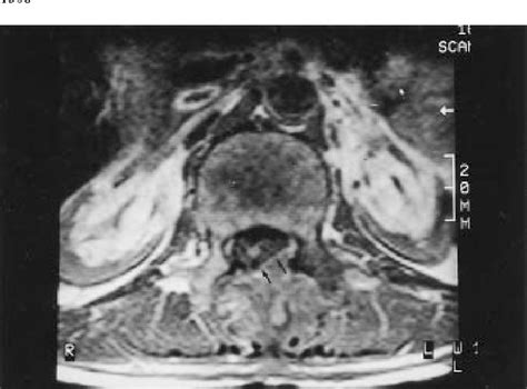 Figure 4 From Pyoderma Gangrenosum And Spinal Epidural Abscess After Subcutaneous Administration