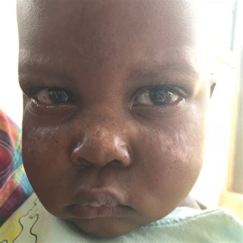 A 3 Year Old Male With Mottled Hypopigmentation Involving The Central