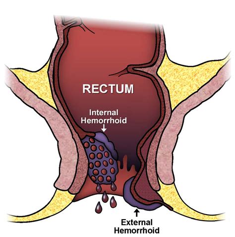 External Hemorrhoid With Rash