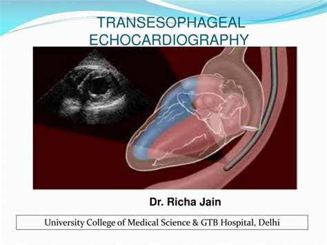 Ppt Transesophageal Echocardiography Powerpoint Presentation Free Download Id 4499960