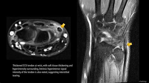 Ultimate Radiology Extensor Carpi Ulnaris Ecu Tendinosis With Interstitial Tear