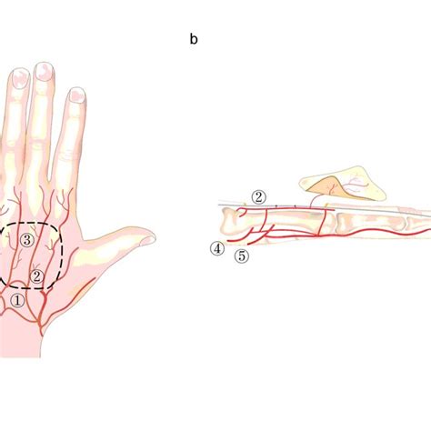 Pdf First Web Space Reconstruction Using The Second Dorsal Metacarpal Artery Cutaneous Flap A
