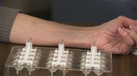 How We Do Skin Tests For Allergies Youtube