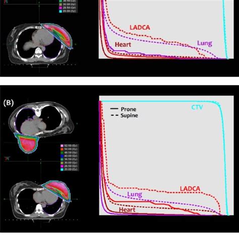 Dosimetric Comparison Of Organs At Risk Between Supine And Prone Download Scientific Diagram