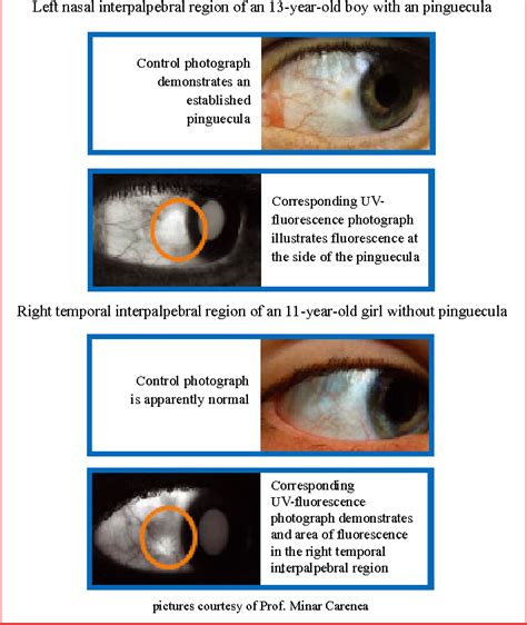 Figure 5 From UV Radiation And The Eye Semantic Scholar