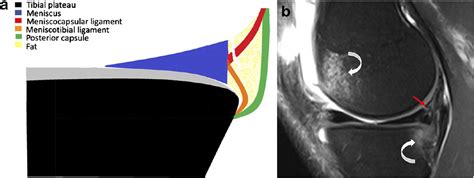Variability Of The Posteromedial Meniscocapsular Junction Of The Knee